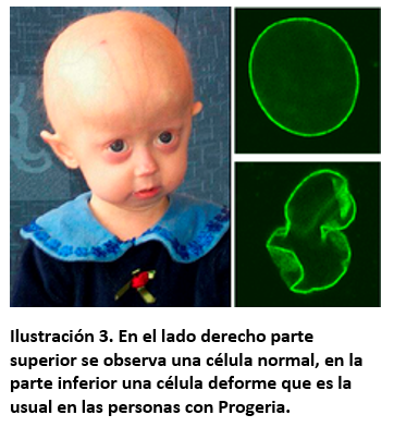 PROGERIA, IMPLICACIONES SOCIALES Y MEDICAS.