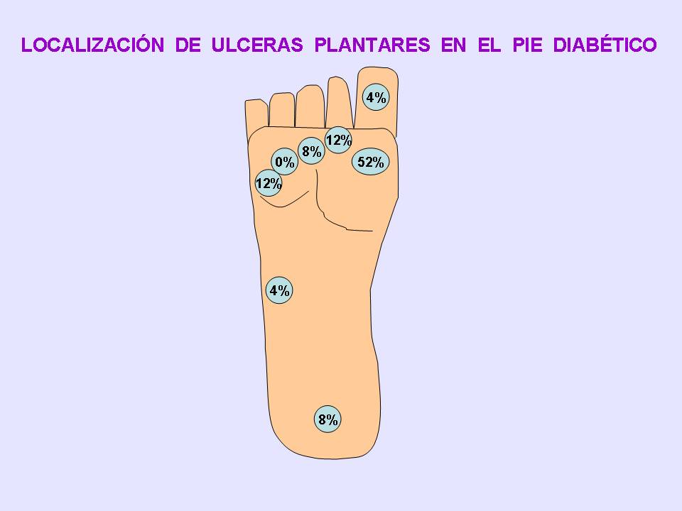 Las úlceras diabéticas del pie diabético pueden curarse con un ...