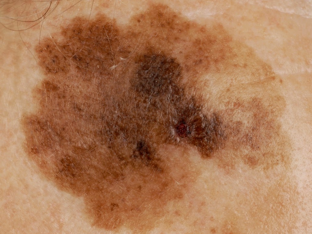 SKIN DISEASE TYPES: Lentigo Simplex (Skin Disease Type)