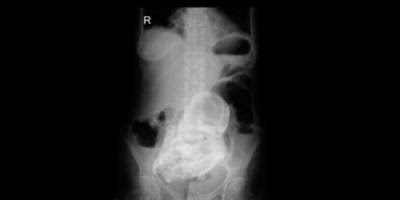 Brazil Weird News: + A CASE OF LITHOPEDION - THE STONE BABY OF COLOMBIA