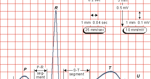 Sinyarma Arveduion: ECG for dummies (3/?) - El ECG normal