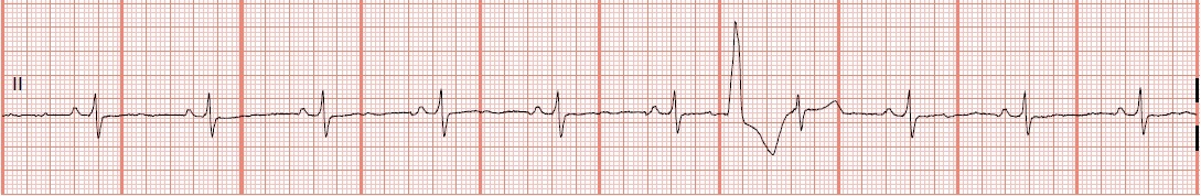 ECG Rhythm Strip Quiz 69