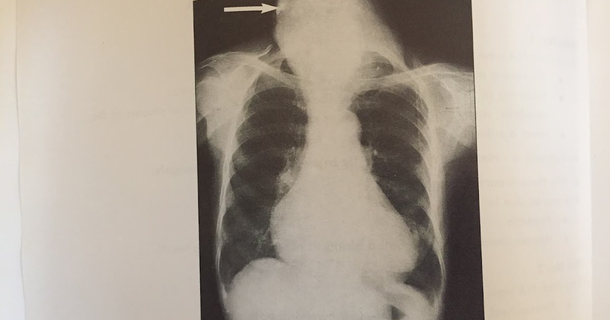 XRAYS OF CALCIFICATION IN NECK