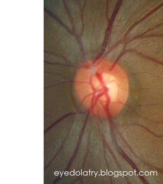 What is Glaucoma? - Eyedolatry