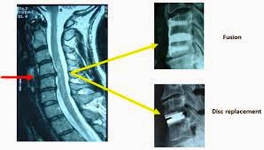 Medical Treatment Pictures-for Better Understanding: Spinal Disc ...