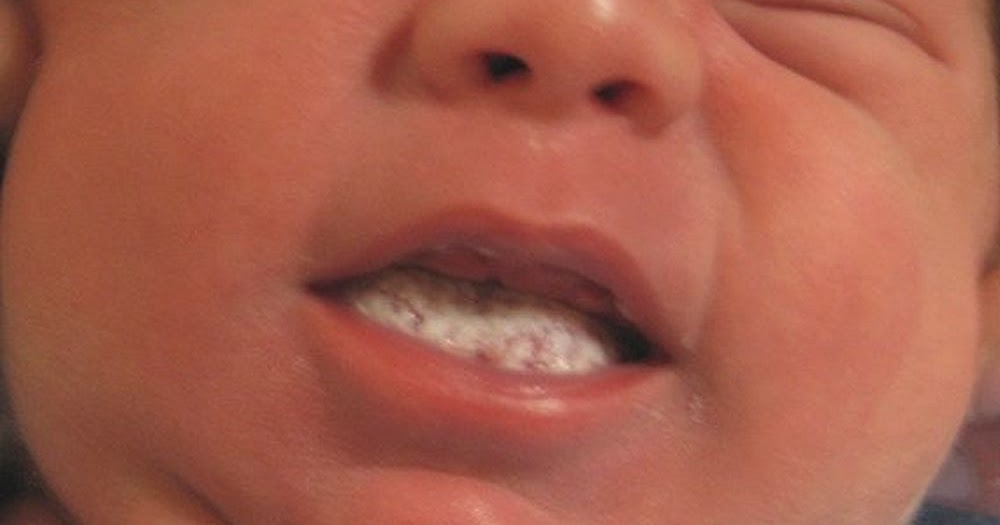 Candidiasis bucal en el recién nacido - odontobebe