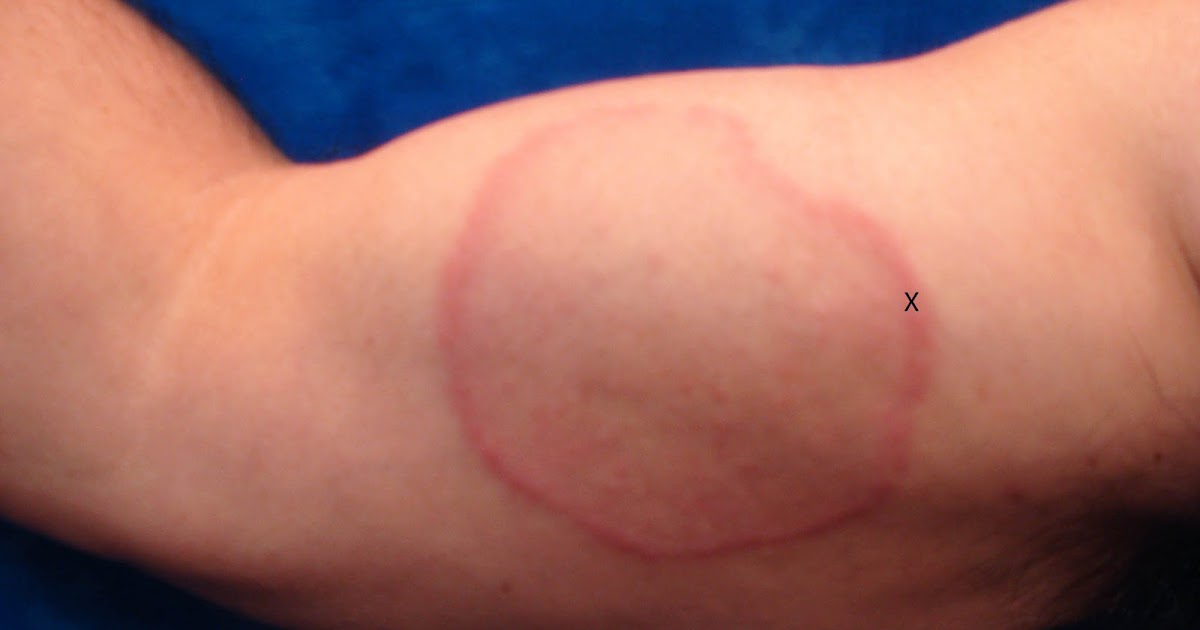 VIRTUAL GRAND ROUNDS IN DERMATOLOGY 2.0: 10 cm annular plaque in a 62 ...