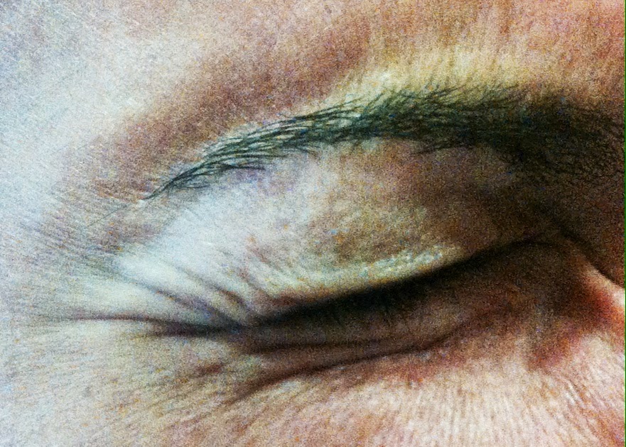 Miranza IOA: BLEFAROESPASMO ESENCIAL