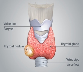 Thyroid Nodules- Types of Thyroid Nodules and Treatments