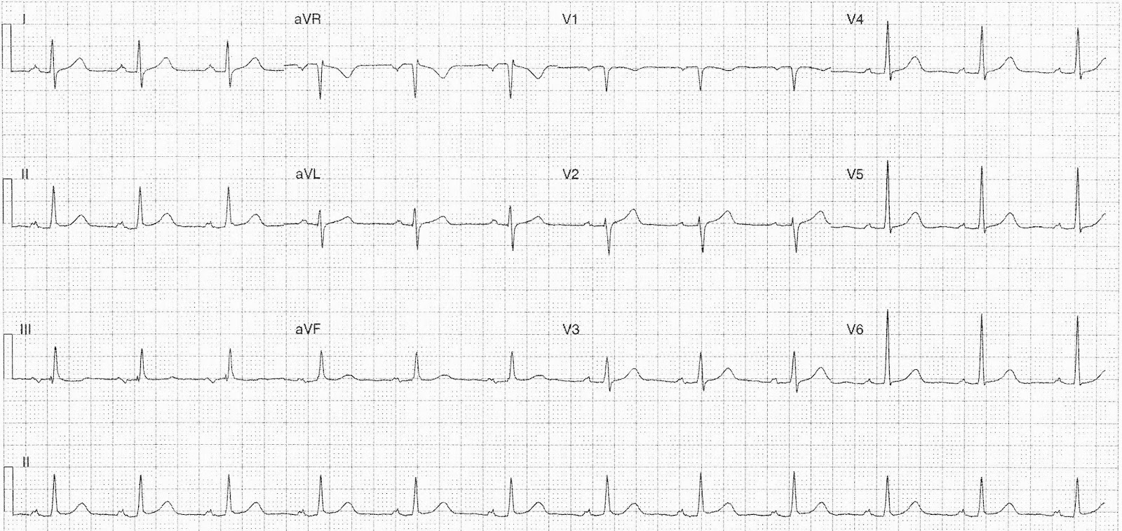 ECG of the Week: ECG of the Week - 11th June 2018