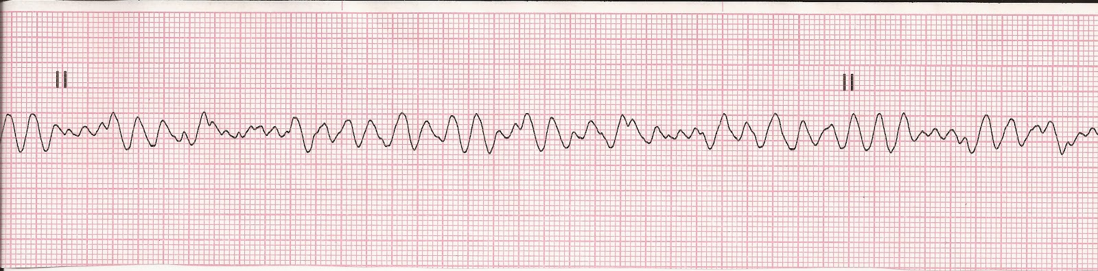 Float Nurse: EKG Rhythm Strip Quiz 25