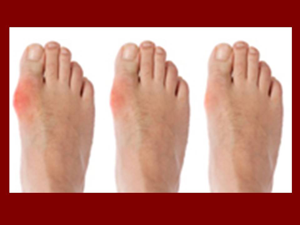 TRUCOS Y CONSEJOS CASEROS: TRUCOS PARA LA GOTA