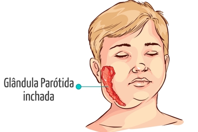Caxumba em Santiago: Em Outubro, foram registrados 22 casos | Rafael Nemitz
