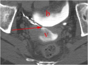 Radiologist For Ever: Male pelvis rule16 : Urinary bladder fistula