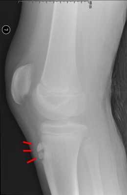 Denis Garcia Corrêa: Doença de Osgood-Schlatter