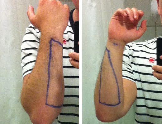 Phalloplastiek Nederland 2011 - 2019/ Phalloplasty experience blog ...