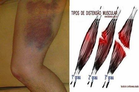 Distensão muscular
