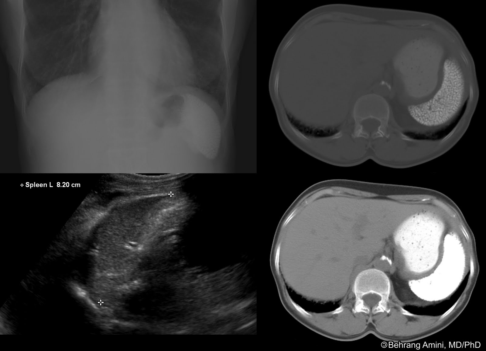 Roentgen Ray Reader: Thorotrast Accumulation in the Spleen