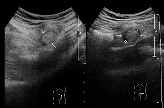 Epiploic appendagitis-Ultrasound - Sumer's Radiology Blog