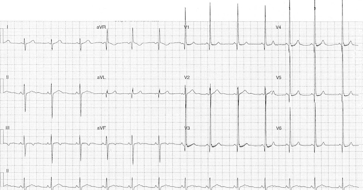 ECG of the Week: ECG of the Week - 17th July 2017 - Interpretation