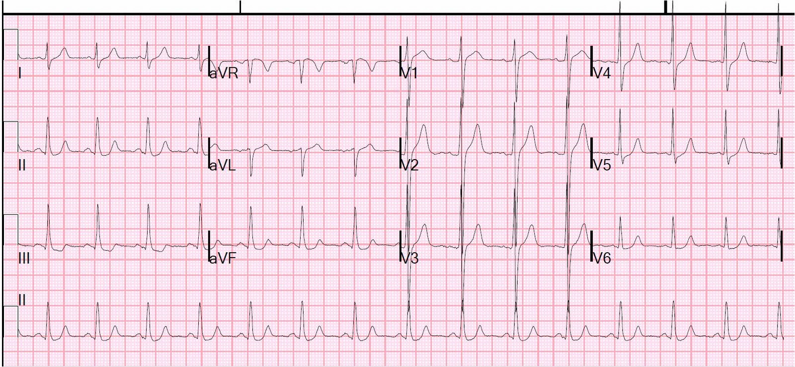 Dr. Smith's ECG Blog: Wide Complex Tachycardia: Ventricular Tachycardia ...