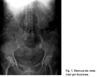 Memorias de un Residente: El Noble Arte del Fecaloma