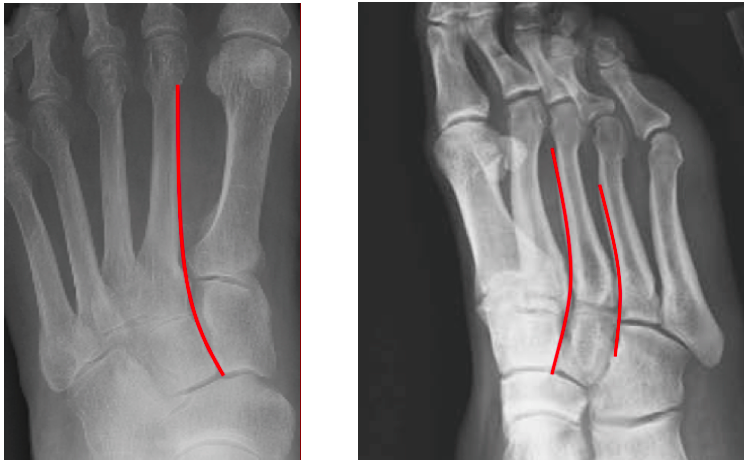 EM Didactic: Lisfranc injuries