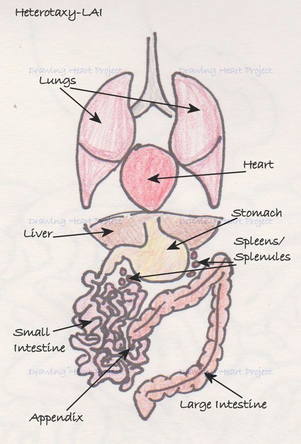 Drawing Heart: Heterotaxy RAI vs LAI