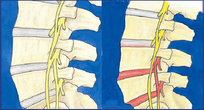 Chiropractic & Laser Therapy: Vertebral Subluxation: How It Is Treated ...