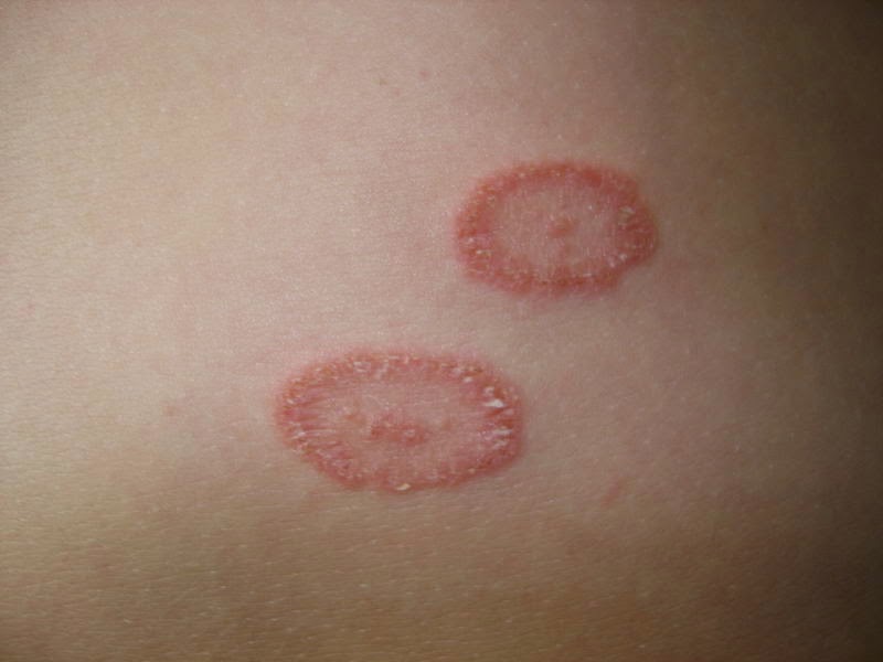 Dermatopathology Made Simple - Inflammatory: Psoriasiform Reaction Pattern