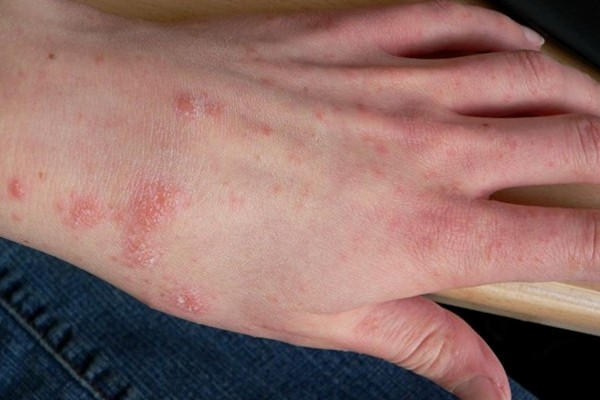 8 Cara Mengobati Kudis Secara Alami Dan Cepat - Obat Alami