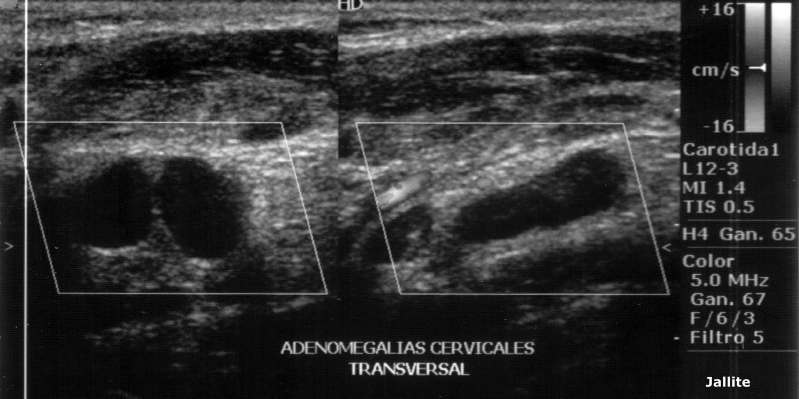 Adenomegalias Cervicales