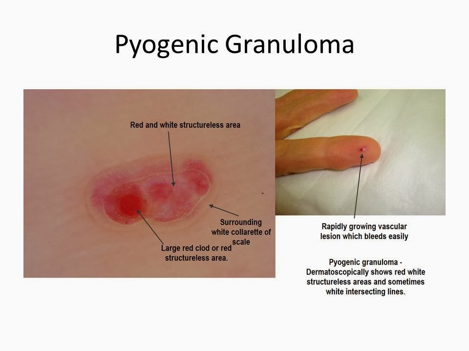 Dermpath Made Simple - Neoplastic: Vascular Tumours