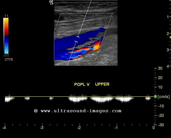 cochinblogs: Ultrasound imaging of popliteal vein thrombosis
