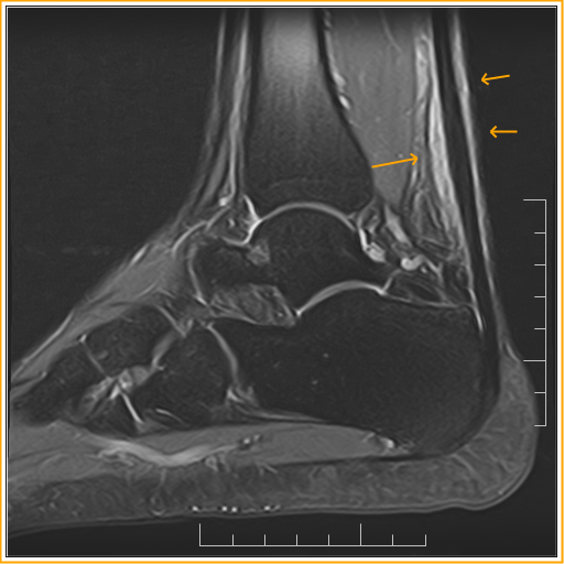 Achilles tendinopathy: MRI - Sumer's Radiology Blog