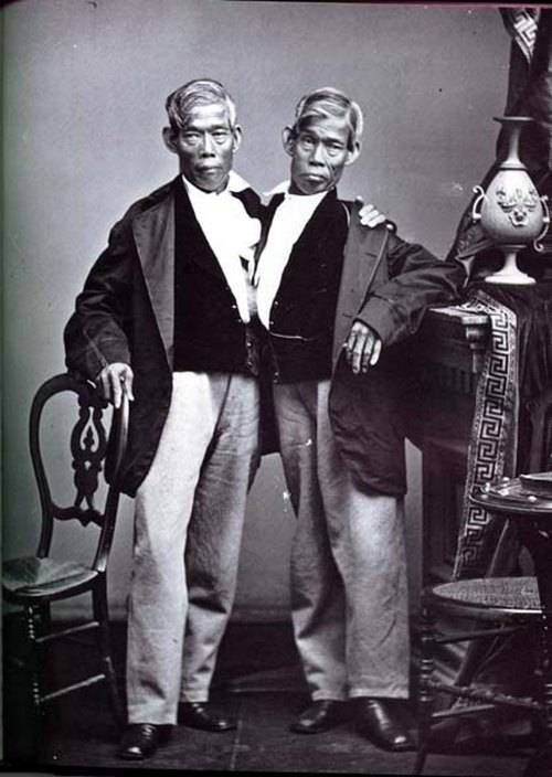 Most Amazing: Conjoined twins Amazing Pictures