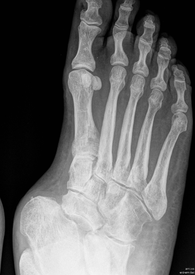 Salud Osteoarticular: CORRECCIÓN DE PIE PLANO-VALGO REUMATICO