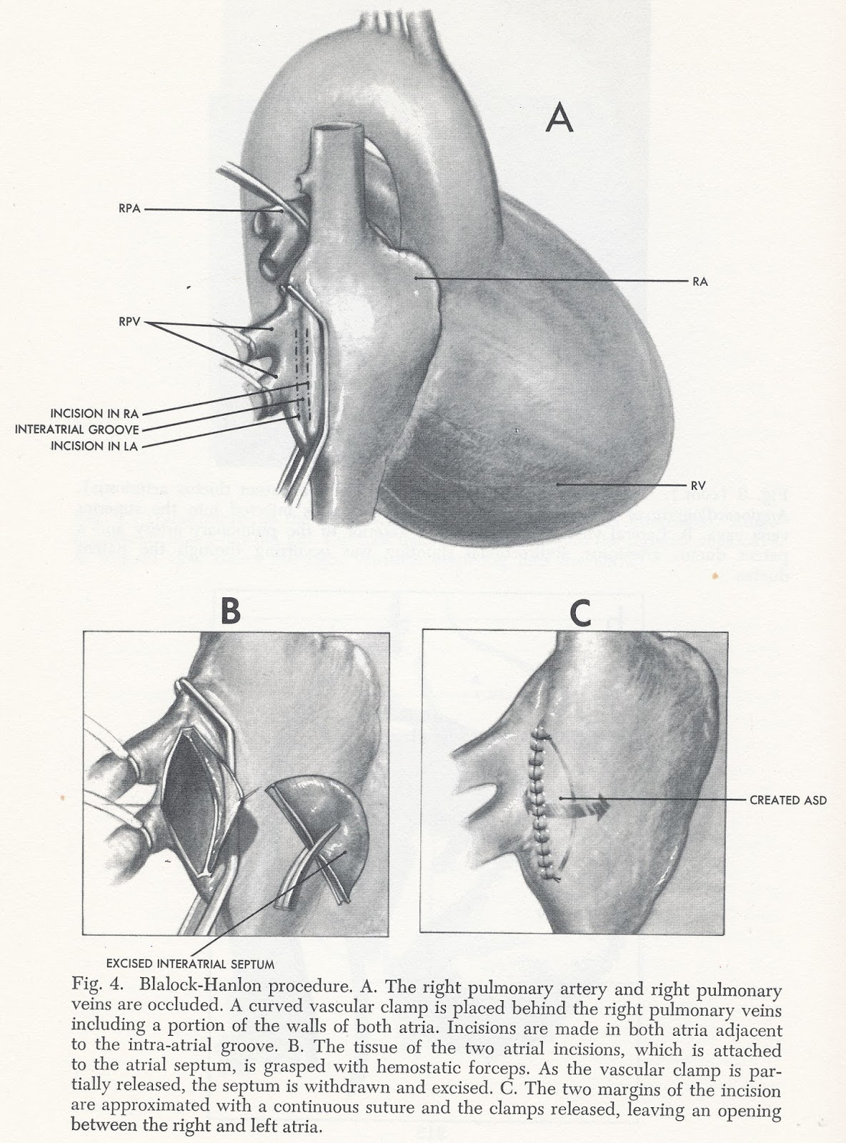 Pedi cardiology: Blalock-Hanlon Atrial Septectomy (d-Transposition of ...