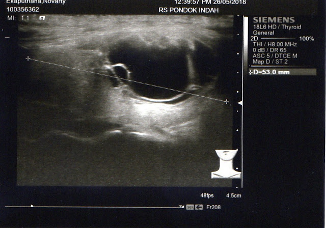 √ Aku dan Kista Tiroid - Novarty