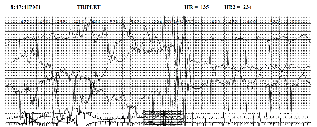 Boxers 101: Intrepreting Holter Reports for Boxer Dogs