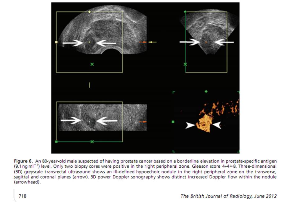 BÀI SOẠN VỀ SIÊU ÂM CHẨN ĐOÁN: 3D Transrectal Ultrasound of Prostate Cancer