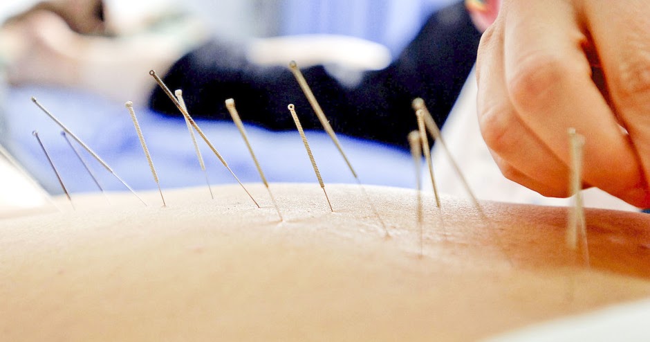 GALERI TERAPI BEKAM (KOP BADAN): Akupunktur membantu untuk ...