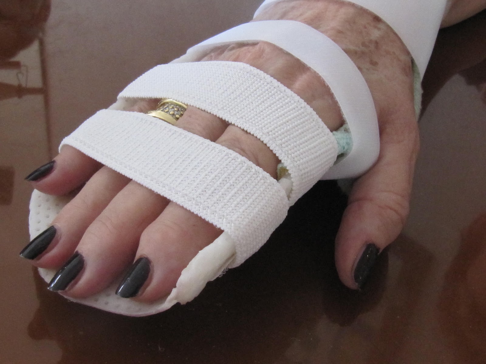 orthèses sur mesure et rééducation spécialisée main et poignet - Lyon ...