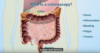 What is colonoscopy
