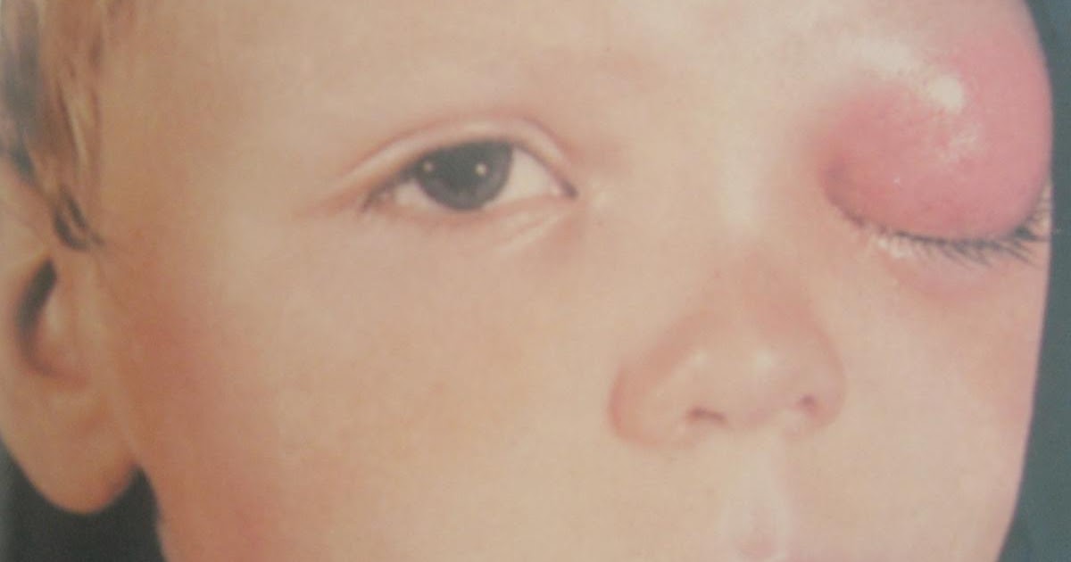 Thai Sanoo: cellulitis คือ