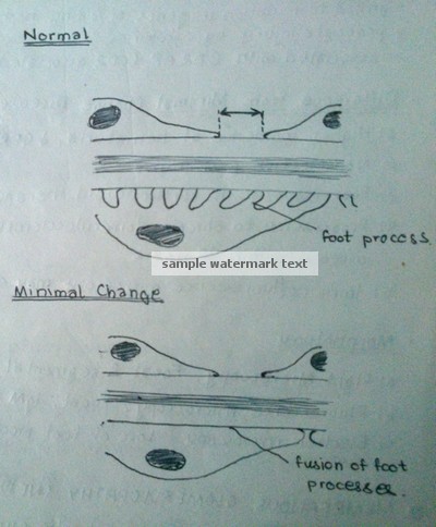 Minimal Change Disease (MCD): Morphology | Medchrome Images