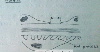 Minimal Change Disease (MCD): Morphology | Medchrome Images