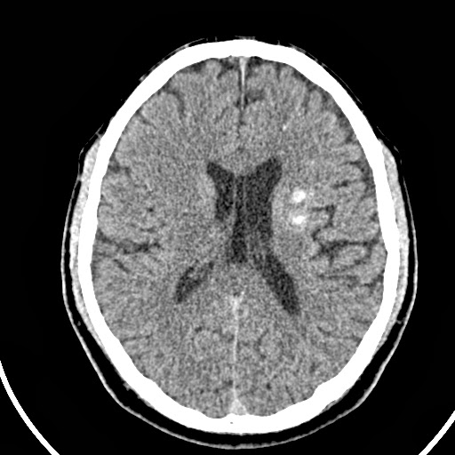 Ultimate Radiology : Multiple Cavernomas in Brain
