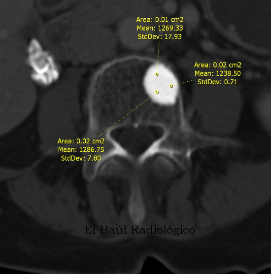 El Baúl Radiológico: ENOSTOSIS: ISLOTE ÓSEO (Bone Island: CT and MRI ...