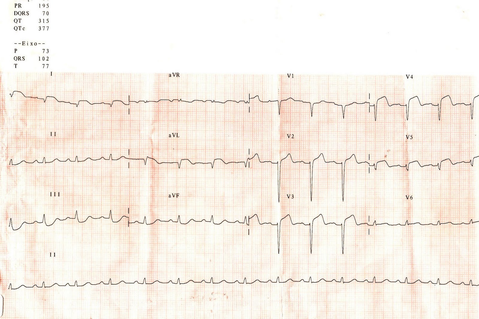 Blog de Eletrocardiografia: ECG NO IAM